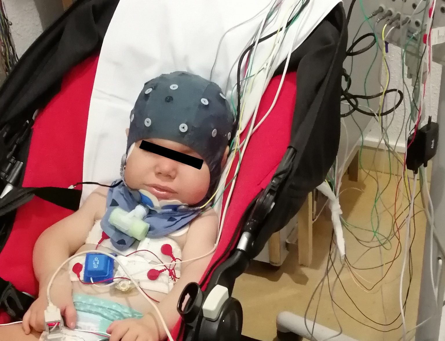 ¿Hay tratamiento para curar el Síndrome Schaaf-Yang?