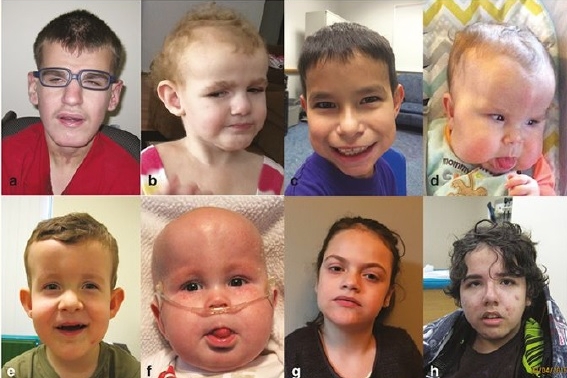 ¿Qué es el Síndrome de Schaaf-Yang (SYS)?